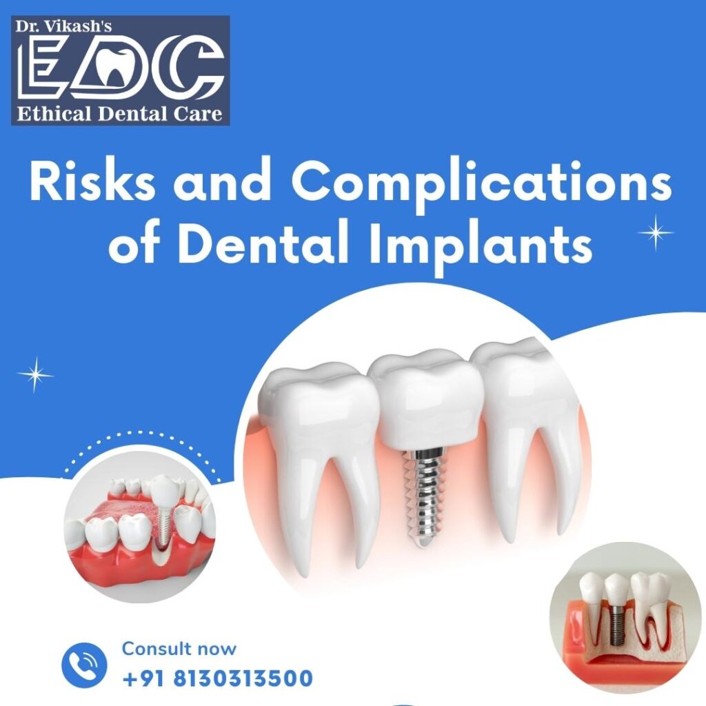 Risks And Complications Of Dental Implants
