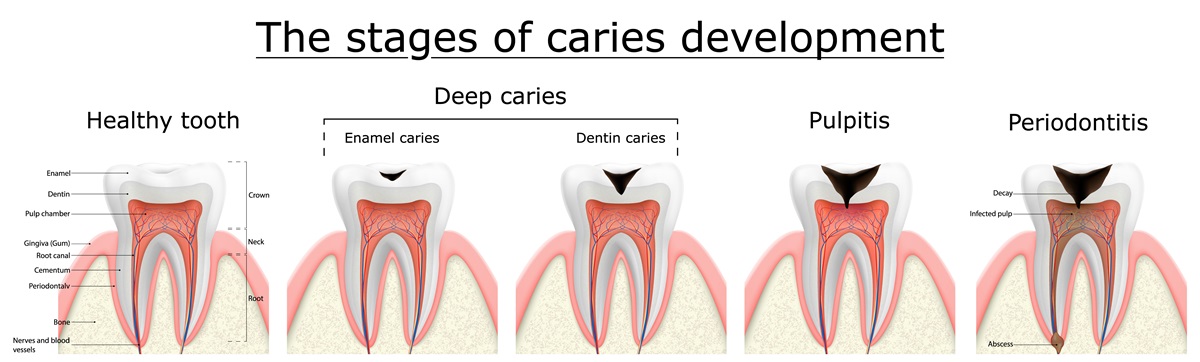 Root Canal Treatment | Single Sitting and Painless RCT in Noida